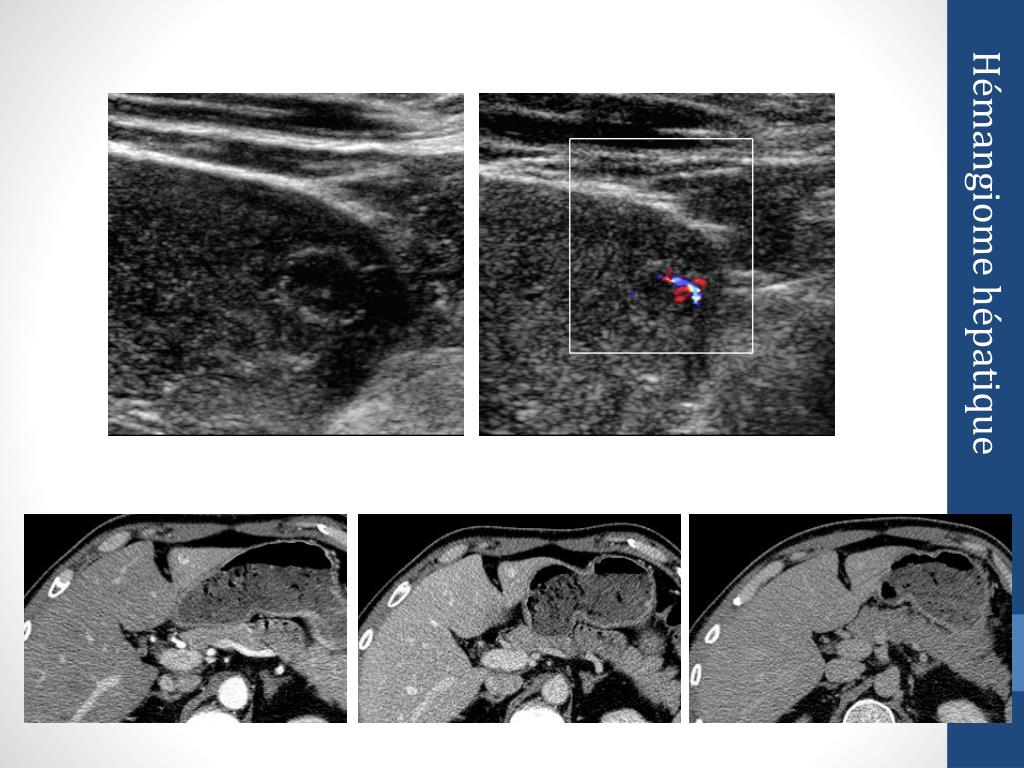 PPT - Imagerie des tu meurs bénignes du foie PowerPoint Presentation ...