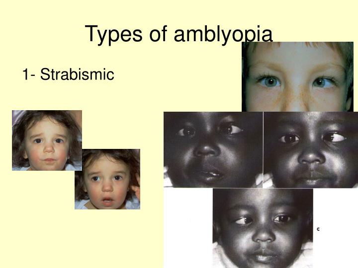 PPT - Amblyopia PowerPoint Presentation - ID:2956318