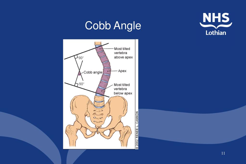 PPT - Physiotherapy Management of Neuromuscular Scoliosis PowerPoint ...