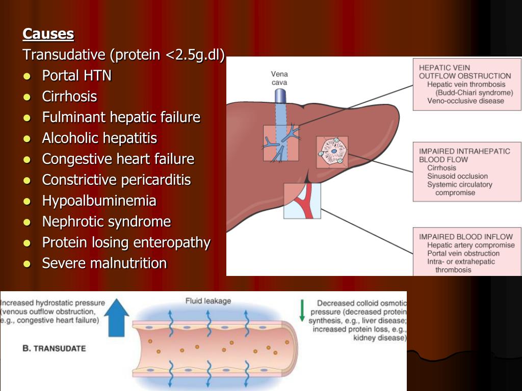 PPT - ASCITES Abnormal accumulation of fluid in the peritoneal cavity ...
