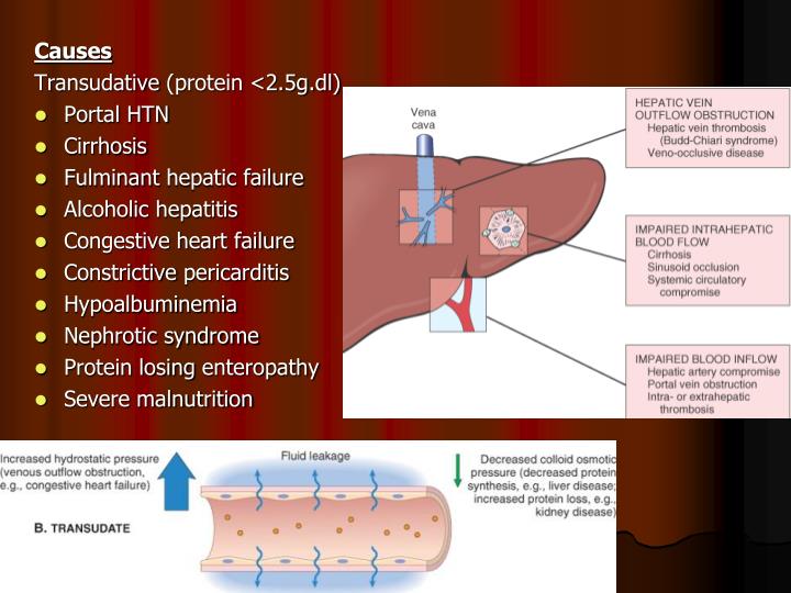 PPT - ASCITES Abnormal accumulation of fluid in the peritoneal cavity ...
