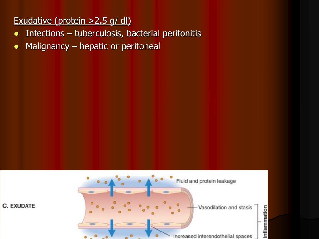 PPT - ASCITES Abnormal accumulation of fluid in the peritoneal cavity ...