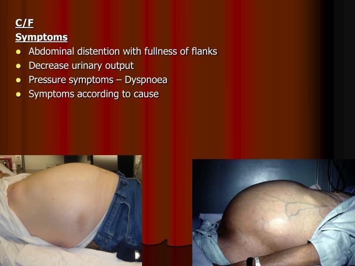PPT - ASCITES Abnormal accumulation of fluid in the peritoneal cavity ...