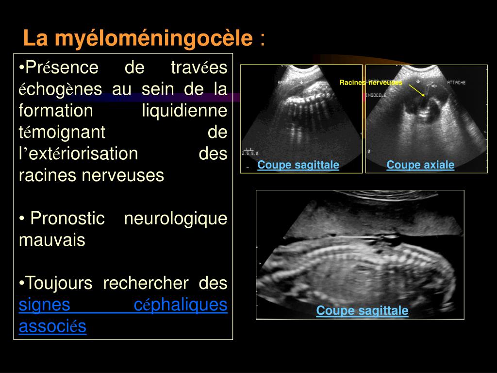 PPT - SIGNES D’APPELS ECHOGRAPHIQUES DANS LE DIAGNOSTIC ANTENATAL DE ...