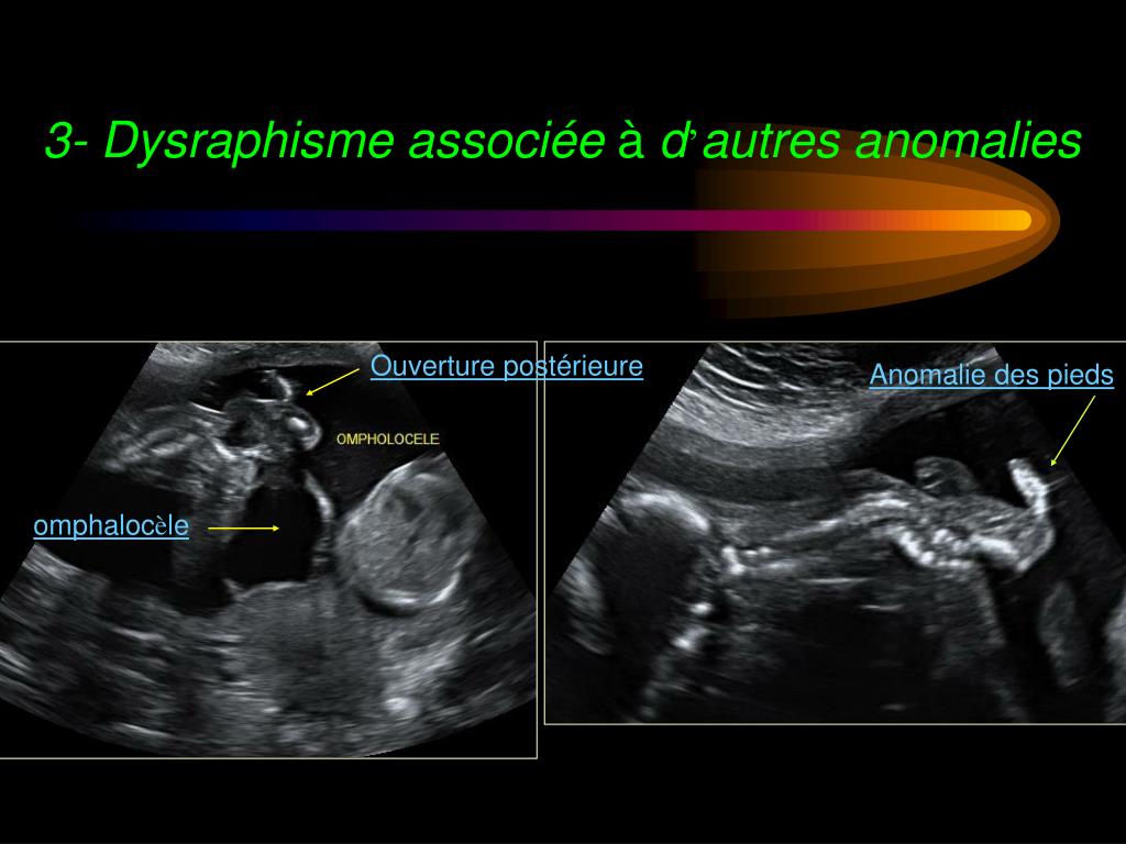PPT - SIGNES D’APPELS ECHOGRAPHIQUES DANS LE DIAGNOSTIC ANTENATAL DE ...