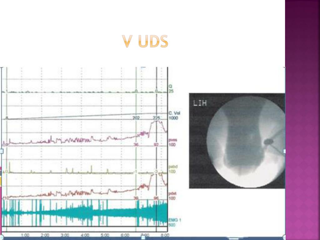 PPT - Evidence Based Management and Treatment of Urinary incontinence ...