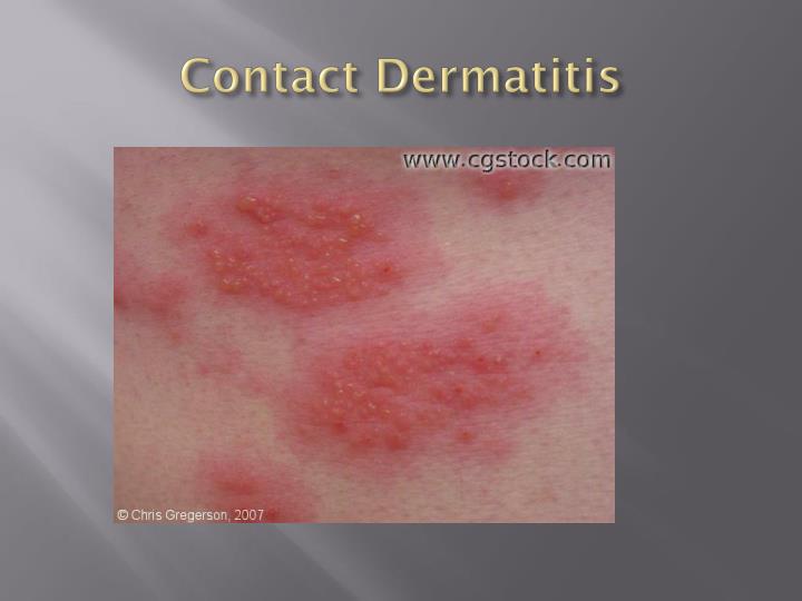 PPT - Integumentary Disorders PowerPoint Presentation - ID:2962510