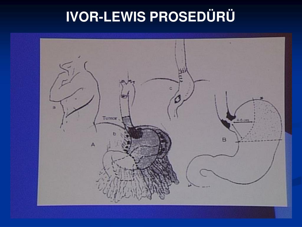 PPT - MİDE CERRAHİSİ ve POSTGASTREKTOMİ SENDROMLARI Prof. Dr. Cavit ÇÖL ...