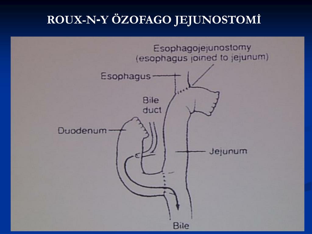 PPT - MİDE CERRAHİSİ ve POSTGASTREKTOMİ SENDROMLARI Prof. Dr. Cavit ÇÖL ...