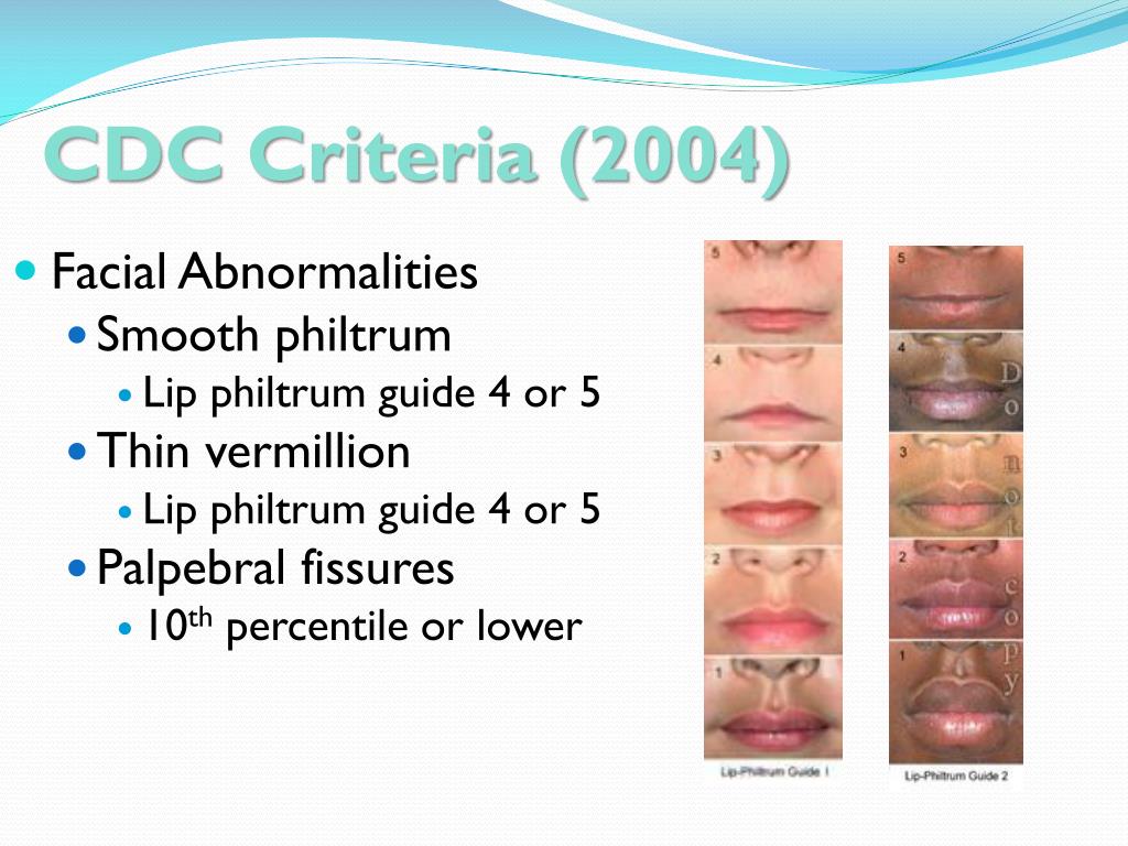 PPT - Fetal Alcohol Spectrum Disorders: Screening, Diagnosis, and ...