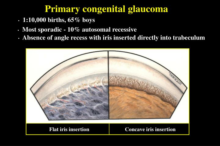 PPT - CONGENITAL GLAUCOMAS PowerPoint Presentation - ID:2967120
