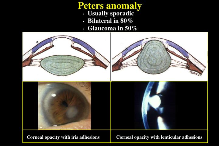 PPT - CONGENITAL GLAUCOMAS PowerPoint Presentation - ID:2967120