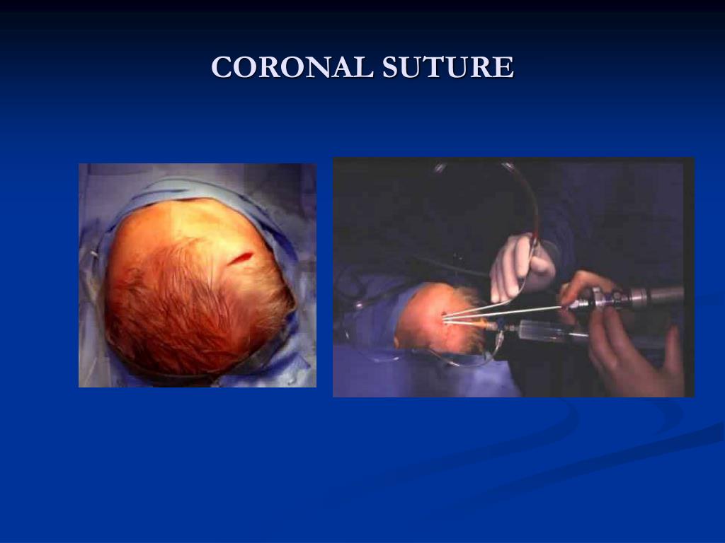 PPT - Endoscopic Treatment of Craniosynostosis Our Approach May 8, 1997 ...