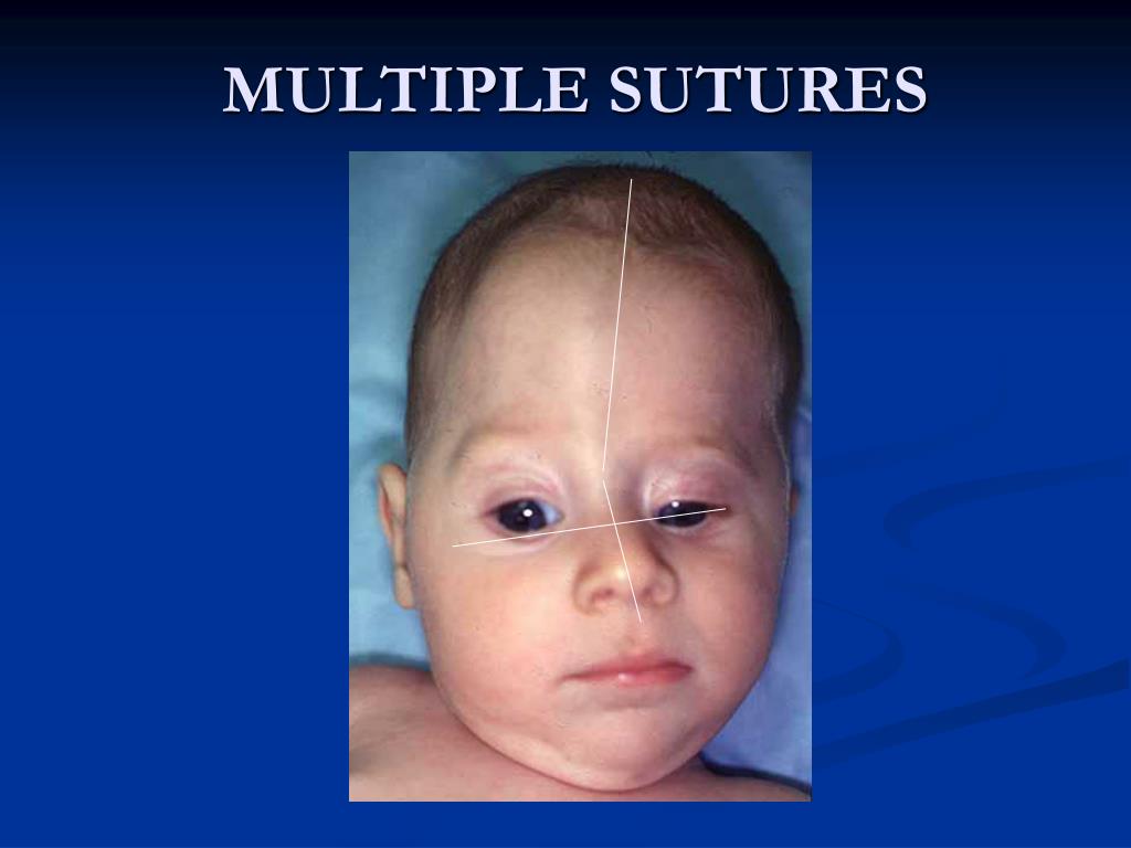 PPT - Endoscopic Treatment of Craniosynostosis Our Approach May 8, 1997 ...