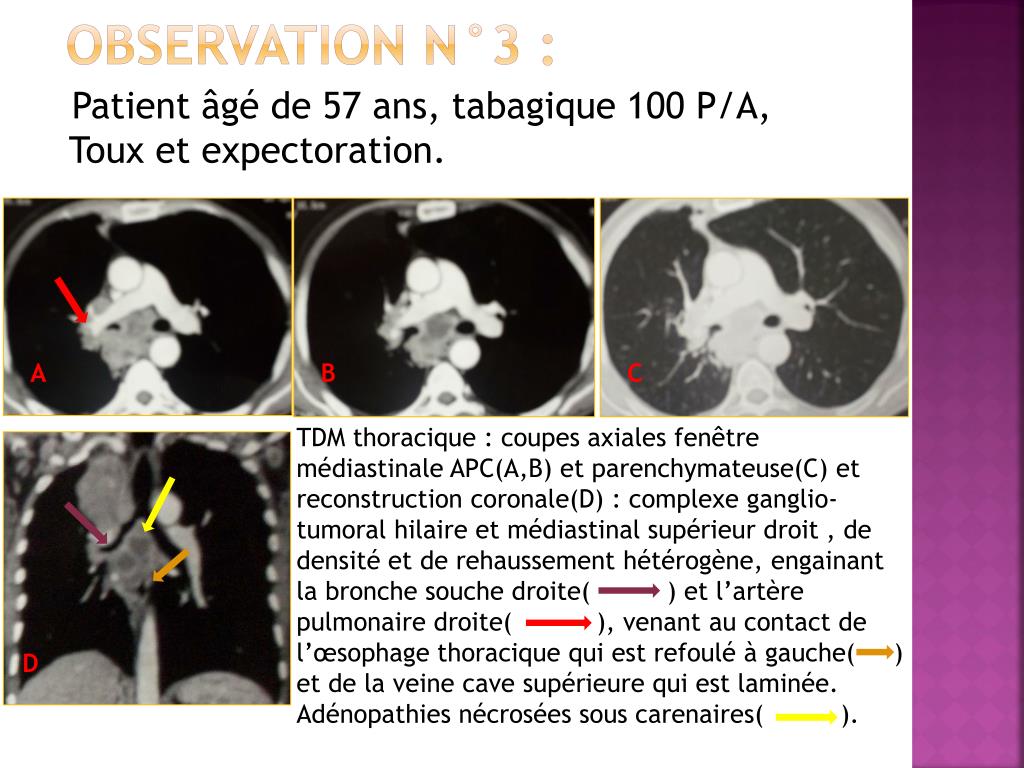 PPT - Caracteristiques tomodensitometriquEs du carcinome epidermoide ...