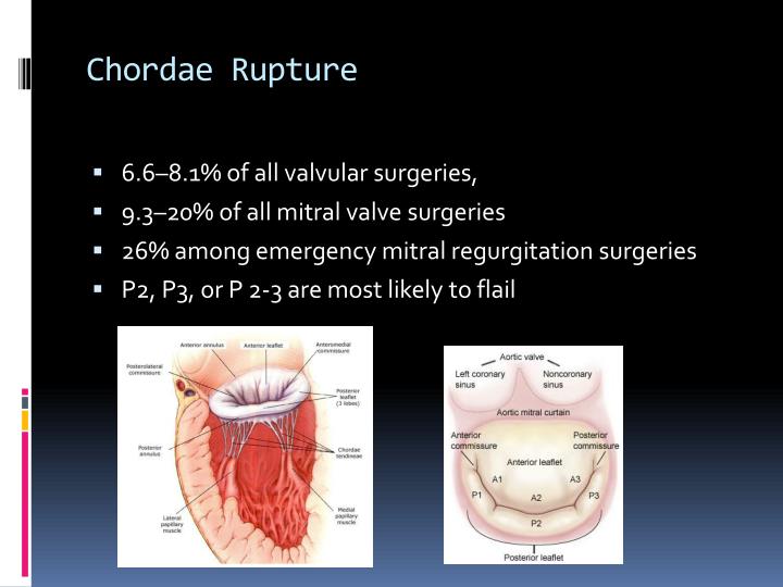 PPT - CHORDAE TENDINeAE RUPTURE PowerPoint Presentation - ID:2970459