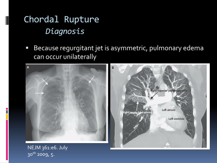 PPT - CHORDAE TENDINeAE RUPTURE PowerPoint Presentation - ID:2970459