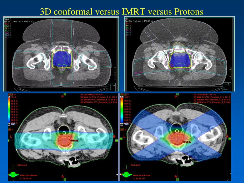 PPT - Radiation therapy for Early Stage Prostate Cancer PowerPoint ...