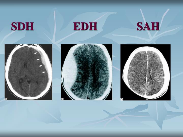 PPT - Head injury and role of anaesthesiologist in management ...
