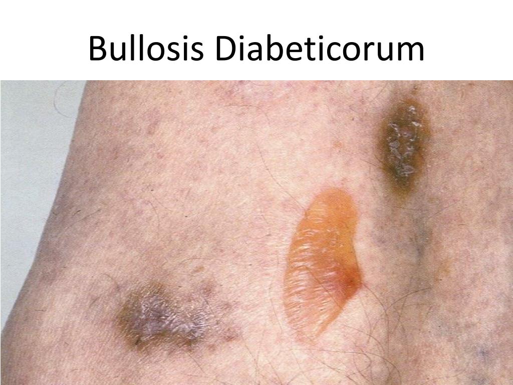 PPT - Cutaneous Manifestations of Diabetes Mellitus PowerPoint ...
