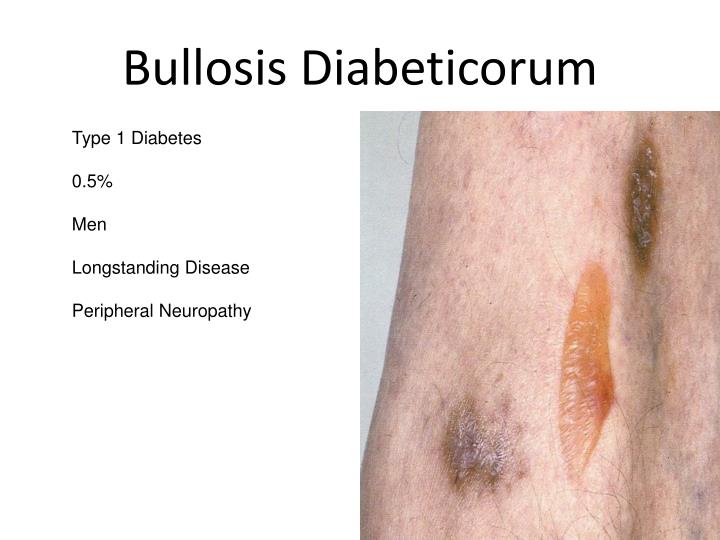 PPT - Cutaneous Manifestations of Diabetes Mellitus PowerPoint ...