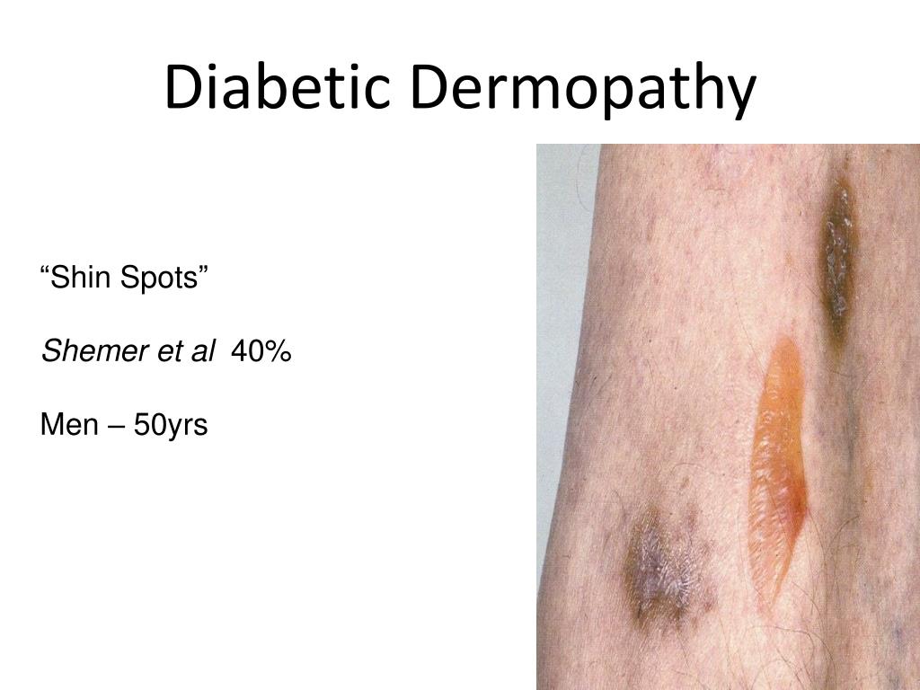 PPT - Cutaneous Manifestations of Diabetes Mellitus PowerPoint ...