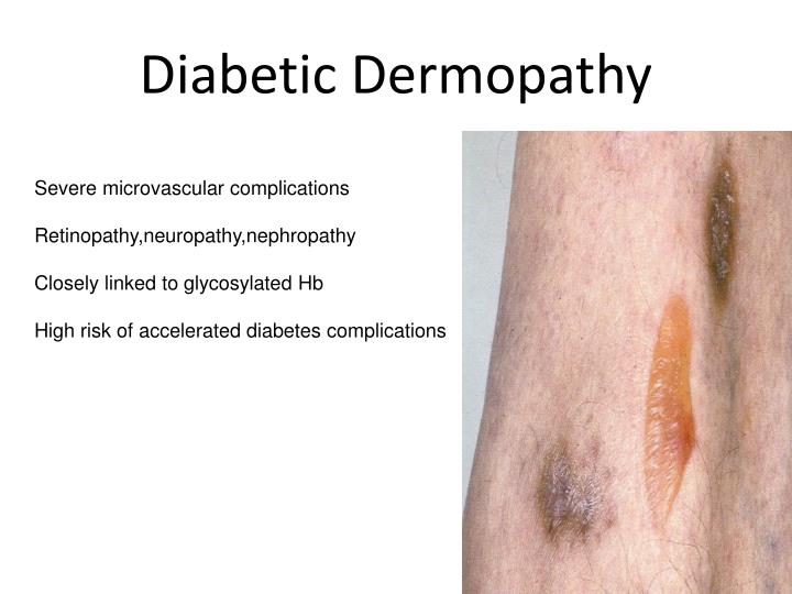 PPT - Cutaneous Manifestations of Diabetes Mellitus PowerPoint ...