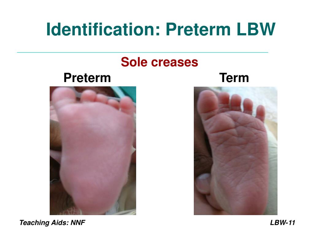 PPT - Management of Low Birth Weight Babies PowerPoint Presentation ...
