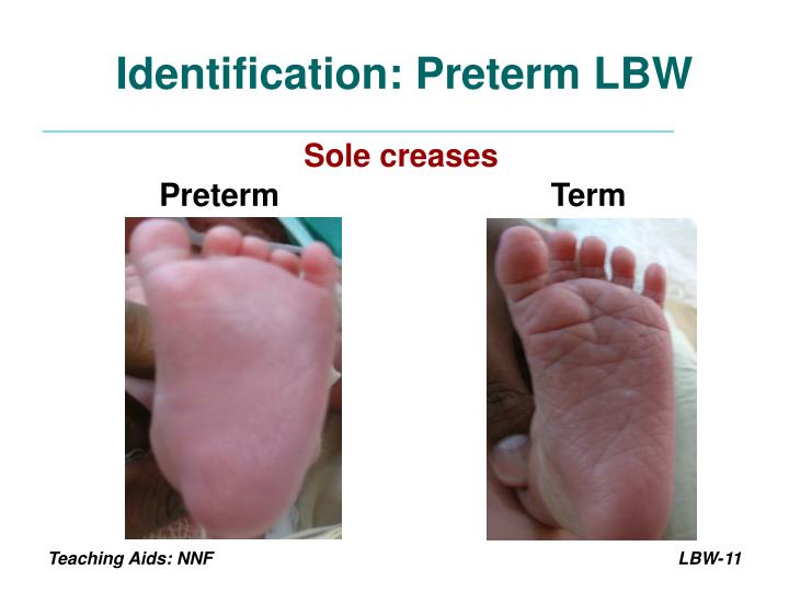 PPT - Management of Low Birth Weight Babies PowerPoint Presentation ...
