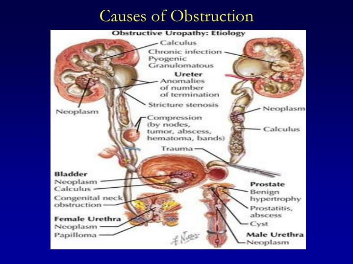 PPT - Obstructive Uropathy PowerPoint Presentation - ID:2976129