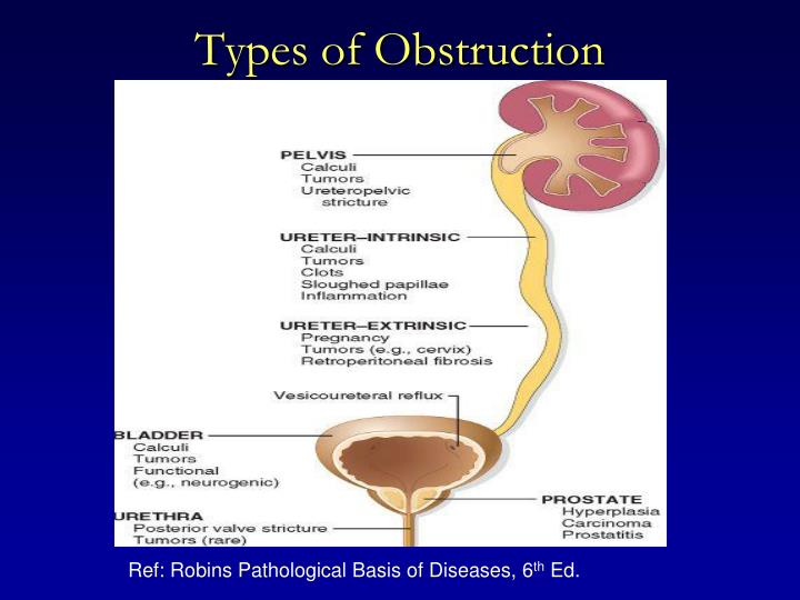 PPT - Obstructive Uropathy PowerPoint Presentation - ID:2976129