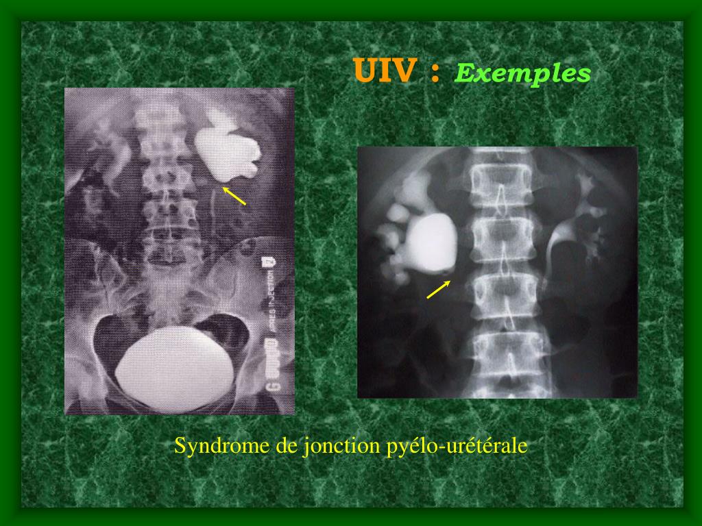 PPT - Séméïologie uro-néphrologique 2) Examens complémentaires ...