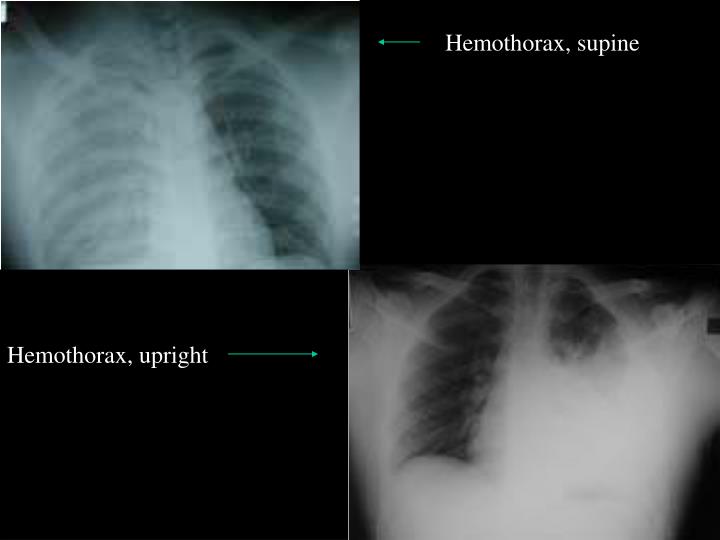 PPT - Penetrating Chest Wounds, Pneumothorax, Tension Pneumothorax and ...