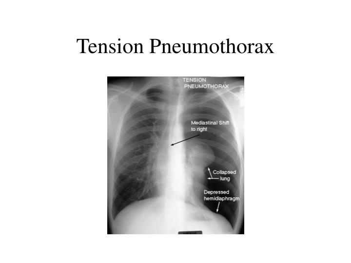 PPT - Penetrating Chest Wounds, Pneumothorax, Tension Pneumothorax and ...