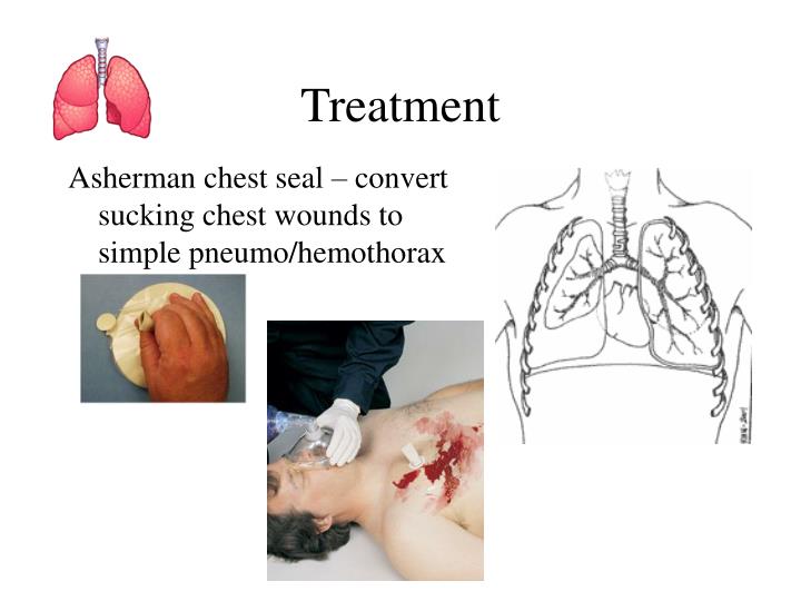 PPT - Penetrating Chest Wounds, Pneumothorax, Tension Pneumothorax and ...