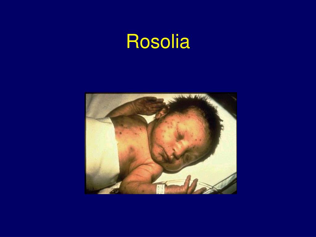 PPT - Epidemiologia e manifestazioni cliniche PowerPoint Presentation ...