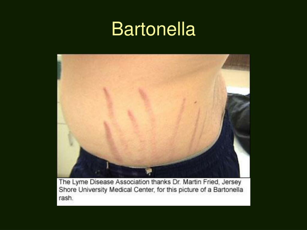 PPT - Non-Antibiotic Approaches to the Management of Lyme Disease and ...