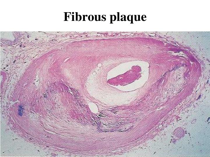 PPT - Coronary Atherosclerosis PowerPoint Presentation - ID:2979508