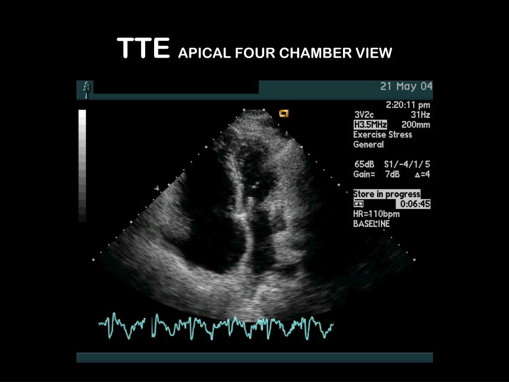 PPT - ADULT CONGENITAL HEART DISEASE- COMMON CONDITIONS PowerPoint ...