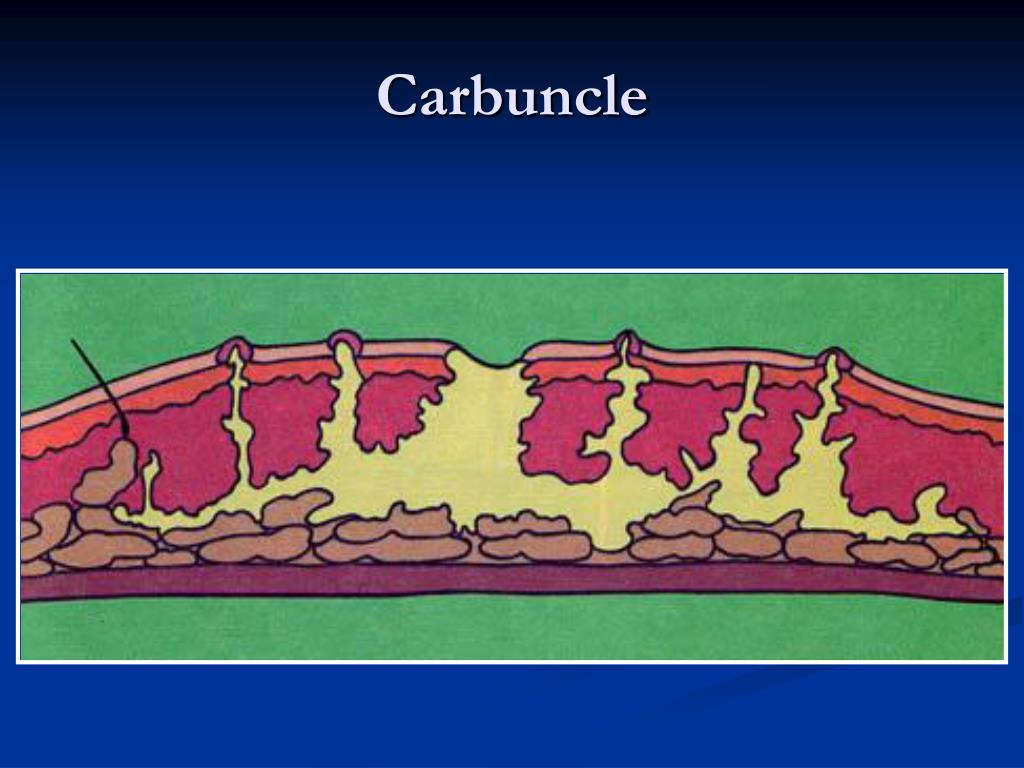 PPT - Surgical Infection. Acute Purulent Infection of the Skin and ...