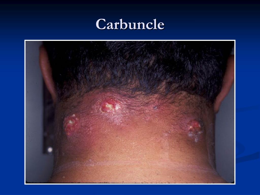 PPT - Surgical Infection. Acute Purulent Infection of the Skin and ...