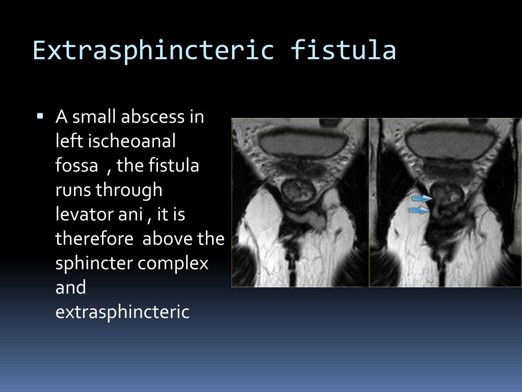 PPT - MRI imaging of Perianal fistula PowerPoint Presentation, free ...