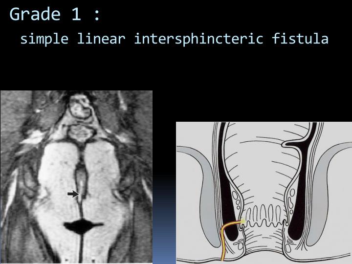 PPT - MRI imaging of Perianal fistula PowerPoint Presentation - ID:2986971
