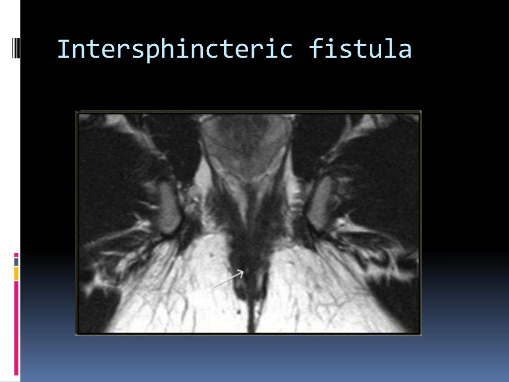 PPT - MRI imaging of Perianal fistula PowerPoint Presentation, free ...