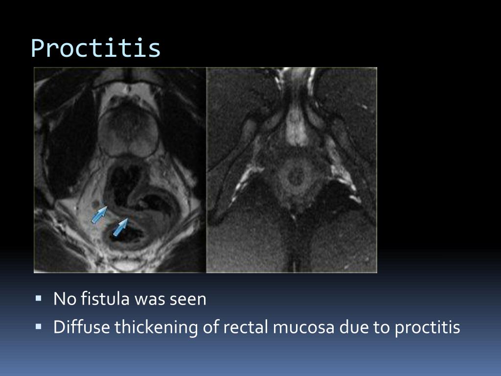 PPT - MRI imaging of Perianal fistula PowerPoint Presentation, free ...
