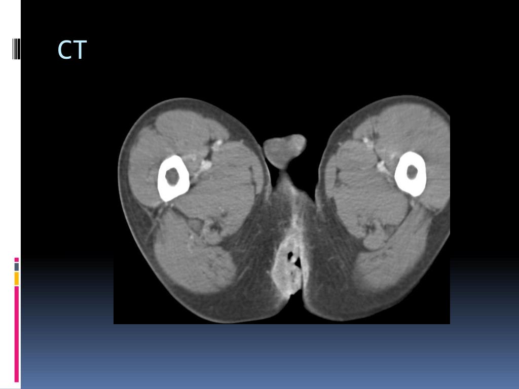 PPT - MRI imaging of Perianal fistula PowerPoint Presentation, free ...