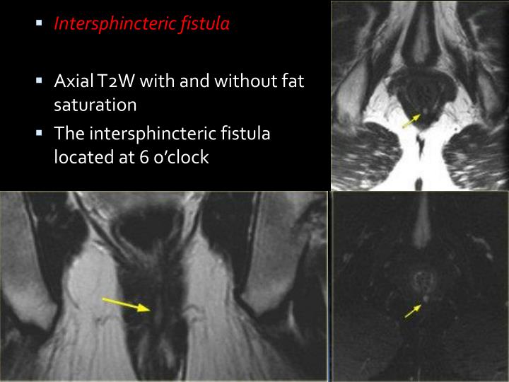 PPT - MRI imaging of Perianal fistula PowerPoint Presentation - ID:2986971