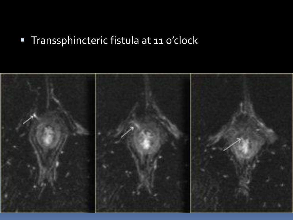 PPT - MRI imaging of Perianal fistula PowerPoint Presentation, free ...