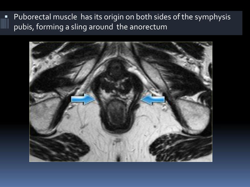 PPT - MRI imaging of Perianal fistula PowerPoint Presentation, free ...