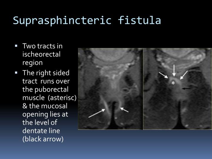 PPT - MRI imaging of Perianal fistula PowerPoint Presentation - ID:2986971